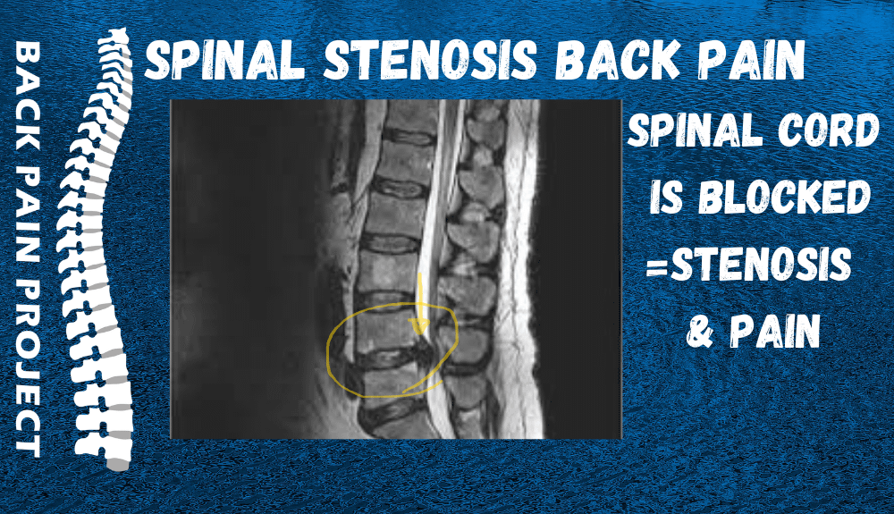 Low Back Pain Due to Spinal Stenosis - The Back Pain Project
